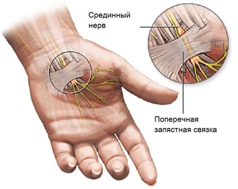 Что такое синдром карпального канала?