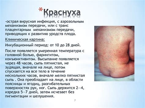 Детские инфекционные болезни - презентация онлайн