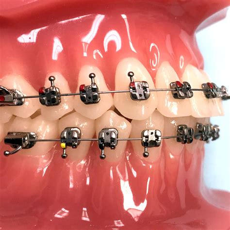 Ортодонтические скобы из металла - Agility® - G&H Orthodontics ...