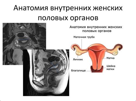 МРТ органов женского малого таза. Доброкачественные образования. Миома ...