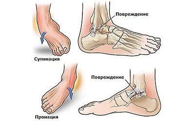 Повреждение голеностопного сустава: симптомы и лечение в Москве в ...