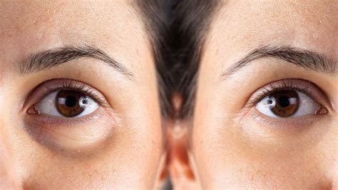 How to Get Rid of Eyebags Naturally Without Surgery? - GTC Beauty