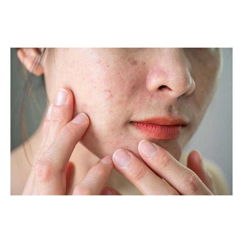 Anti Acne