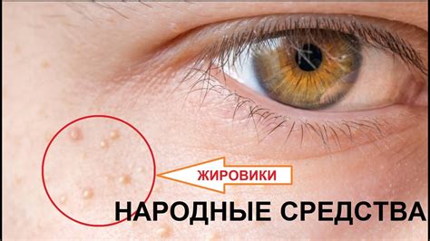 Как удалить жировики на лице#жировик#жировикиудаление - YouTube