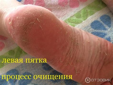 Отзыв о Жидкое лезвие для ороговевших участков тела "Domix" | Я докажу ...