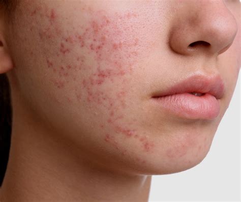 Acne Treatments — Inspirations Med Spa - Portage, MI- Beautiful skin ...