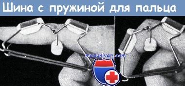 Насильственная пассивная мобилизация кисти и пальцев эластическими шинами