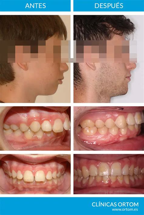 Corrección De La Mandíbula Para Una Sonrisa Perfecta | Ortodoncia Junin