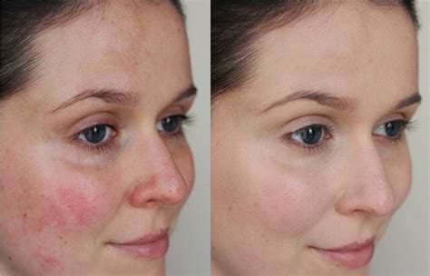 Hvad er en PRX Peeling?