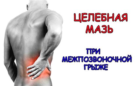 Межпозвоночная грыжа. Целебная мазь при межпозвоночной грыже. - YouTube