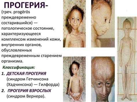 Прогерия - презентация онлайн