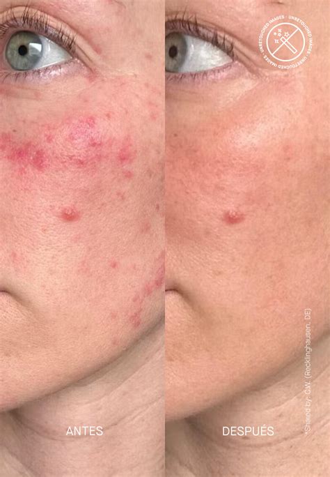 Hochdosiertes treatment mit 3% Ceramiden | Ceramide Treatment ...