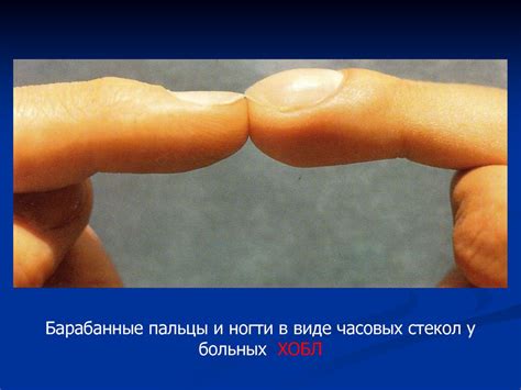 Хронический бронхит - online presentation