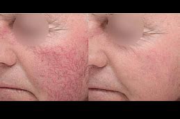 Best Evo Laser in Dubai, Abu Dhabi & Sharjah | Royal Clinic