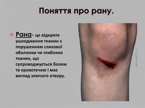 Рани. Характеристика ран. Перша допомога при поранені - презентация онлайн