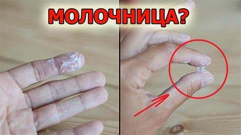 Что такое молочница у женщин | Что такое кандидоз у женщин - YouTube