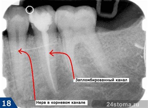Лечение корневых каналов зубов – пломбирование гуттаперчей