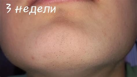 МИНОКСИДИЛ 5% / РЕЗУЛЬТАТЫ МИНОКСИДИЛ / МИНОКСИДИЛ ДЛЯ БОРОДЫ / БОРОДА ...