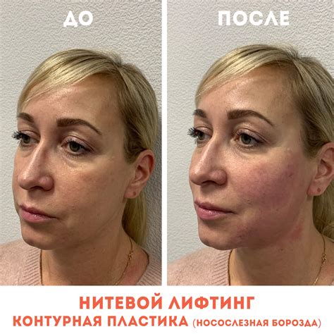 Нити Коги Отзывы Пациентов Фото — Картинки фотографии