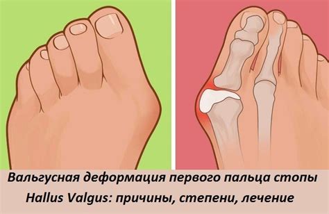 Вальгусная деформация стопы: причины и диагностика, лечение вальгуса ...