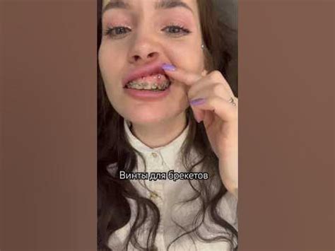 Винты для брекетов - YouTube