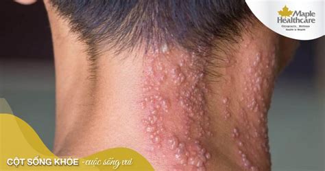 Tìm hiểu về hình ảnh zona thần kinh ở cổ và cách điều trị