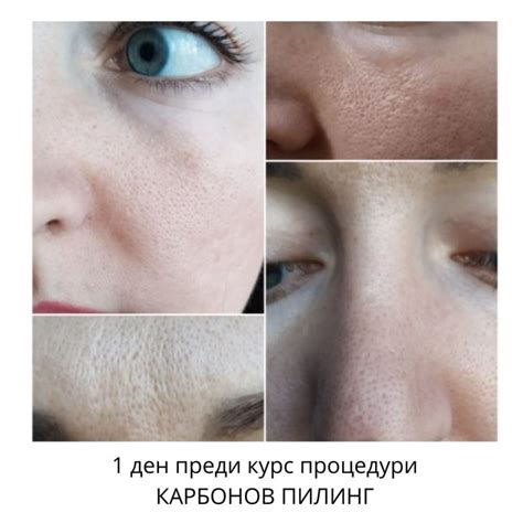 Карбонов Лазерен Пилинг - Приятел в борбата срещу акнето, разширените ...