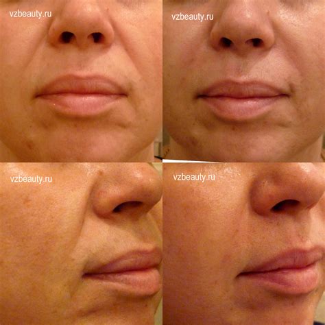Носогубные складки — vzbeauty.ru