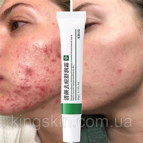 Медицинский крем для лечения угревой сыпи, сужения пор, контроль ...