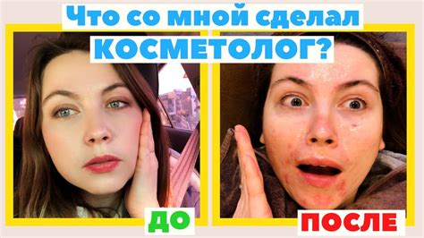 Косметология в Корее. Лечение прыщей на лице. - YouTube