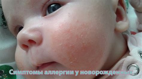 Как проявляется аллергия у новорожденного на фото, ее причины и лечение