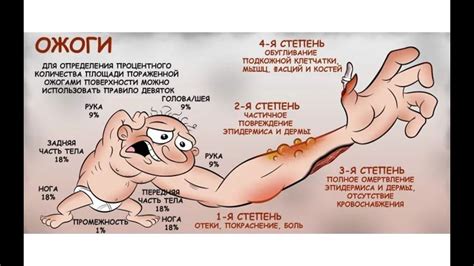 Ожоги. Помощь при ожогах. Виды ожогов - YouTube