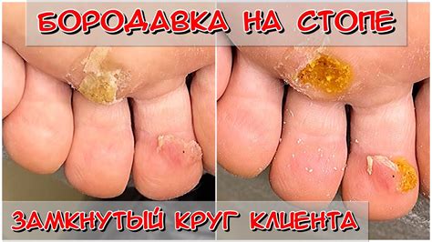 Бородавка на подошве стопы / Бородавки на ноге что делать / Бородавки ...
