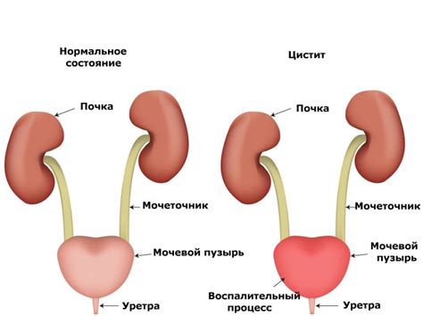 Типы мочеиспускания: проблемы задержки, лечение