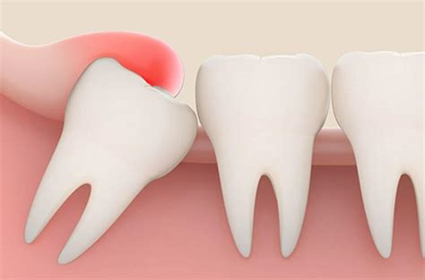 Вирвати зуб мудрості ️ ️ Видалення зуба мудрості в Ірпені | MySmile®
