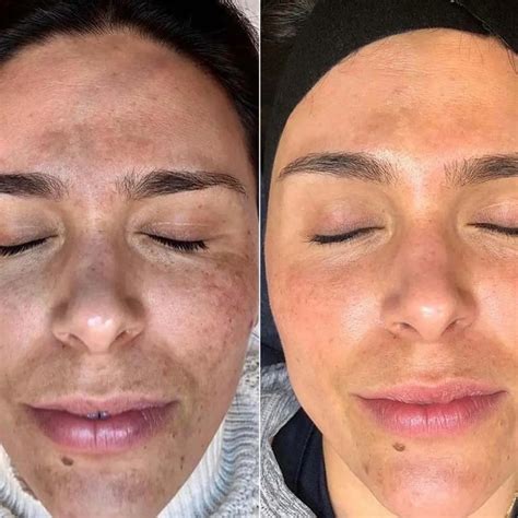 List 90+ Pictures Chemical Peels Before And After Pictures Stunning