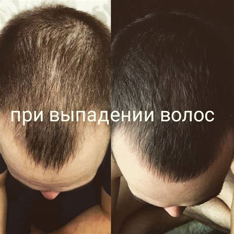 Миноксидил Краснодар (@minoxkrd) • Instagram photos and videos