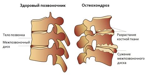 Остеохондроз - симптомы и лечение шейного, поясничного, грудного ...