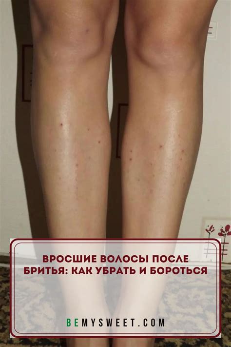 Вросшие волосы после бритья: как убрать и бороться | Бритье, Бритьё ног ...