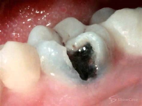Cavity Side Of Molar