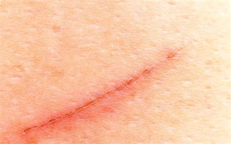 Prevent Scars: The Secret Ingredient You Need for Scar Prevention ...