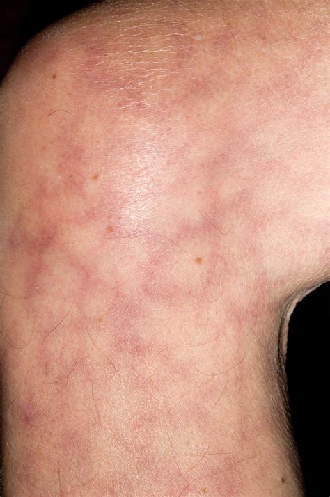 Livedo reticularis || Med-koM