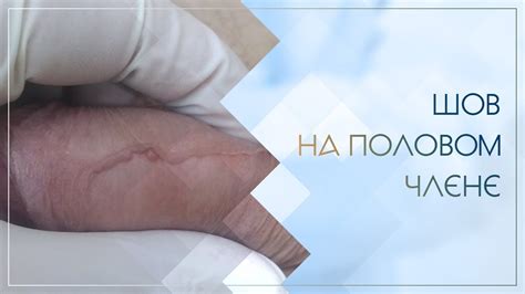 👦 Шов на половом члене. Клинический случай №39 - YouTube