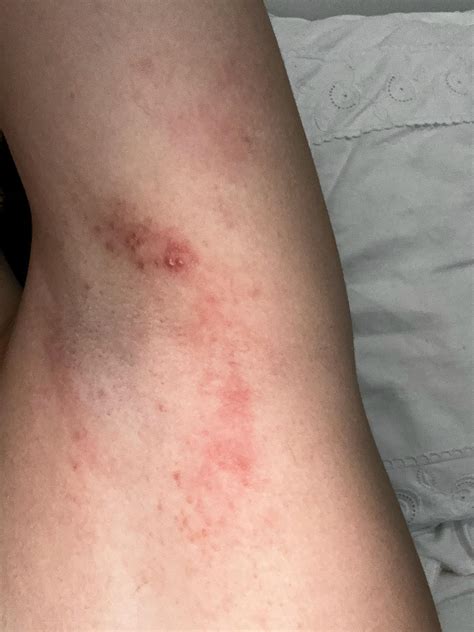 Red Irritated Bumps in Armpit : r/DermatologyQuestions
