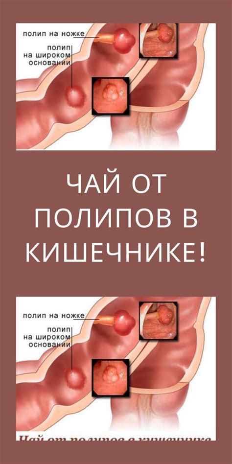 Чай от полипов в кишечнике! | Health advice, Health diet, Herbalism