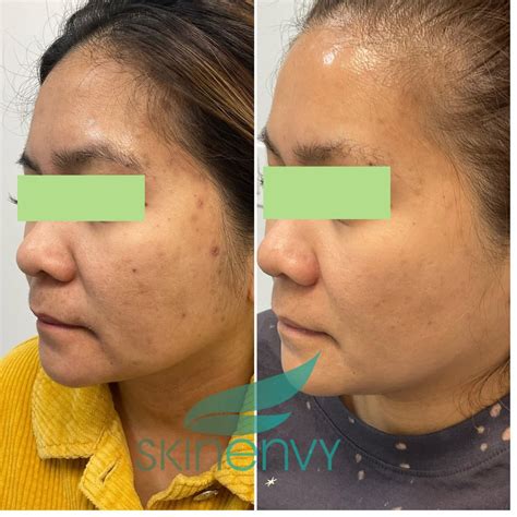 Laser Genesis Treatment In Brooklyn, NY | Skin Envy