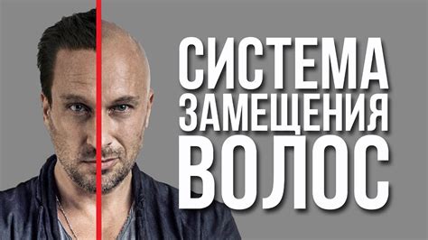 Система замещения волос для лысых мужчин - YouTube