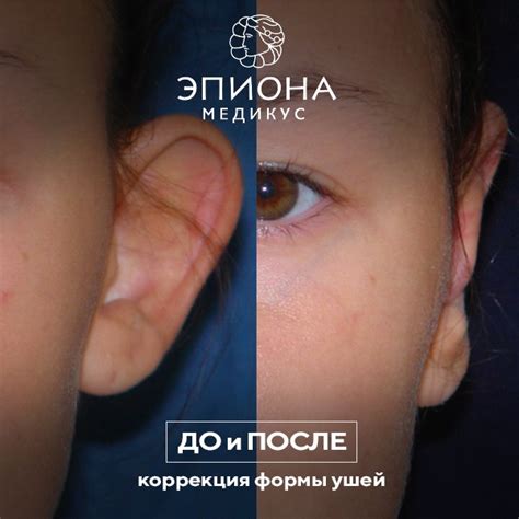Отопластика - Клиника пластической хирургии и косметологи Эпиона Медикус