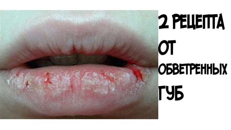 Как БЫСТРО вылечить обветренные губы//В рецепта | Губы, Рецепты, Имена