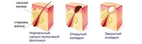 Комедоны на лице – лучшие методы лечения (ТОП-5 процедур)